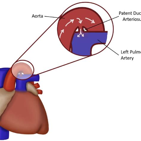 Large Pda Volume Overloading Of Heart Pulsatile Flow Pattern And Download Scientific Diagram