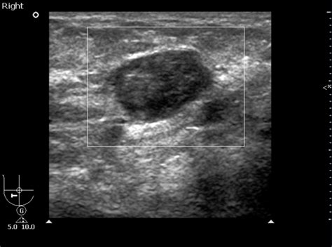 Bi Rads Iii категории