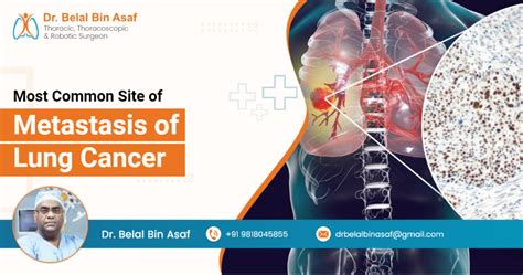 Can A Collapsed Lung Pneumothorax Kill You