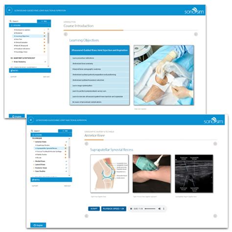 Knee Joint Injection And Aspiration Procedure Sonosim