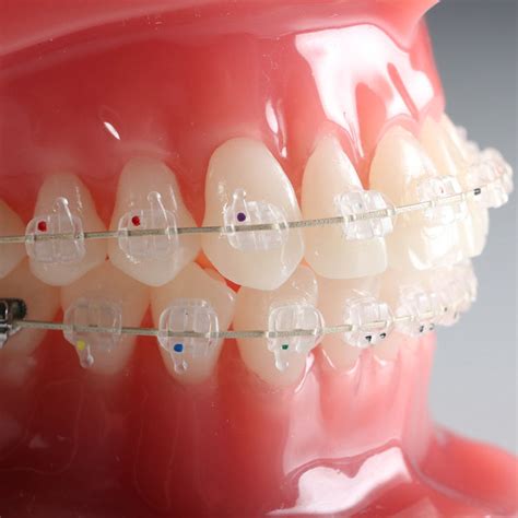 Aesthetic Orthodontic Bracket Vapor™ Gandh Orthodontics Ceramic