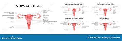 Adenomyosis Illness Set Focal Diffuse Adenomyoma And Normal Uterus With Inscriptions