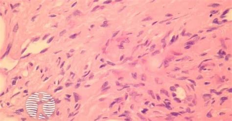 Dermatofibrosarcoma Protuberans Pathology Image