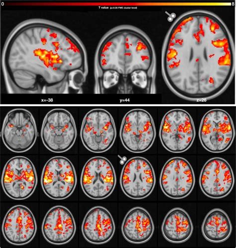 Dr Zohreh Majd On Linkedin Neural Response During Prefrontal Theta Burst Stimulation Interleaved