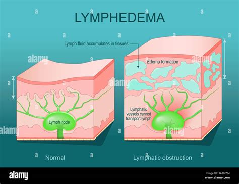 Lymphedema Cross Section Of A Human Skin With Healthy Lymphatic System