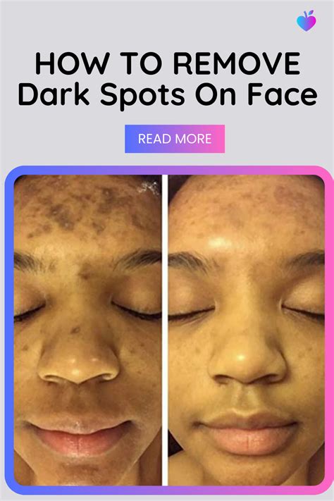 Remove Blemishes Spots