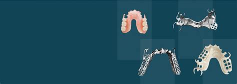 Partial Denture Clasp Types Stomadent Dental Lab