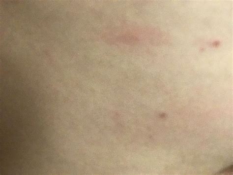 针眼大小的小红点，发痒 手心发痒有小红点 随意云