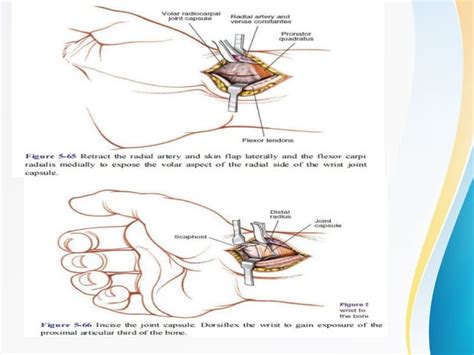 Scaphoid Fracture 1 Pptxccccccccccccccc Ppt