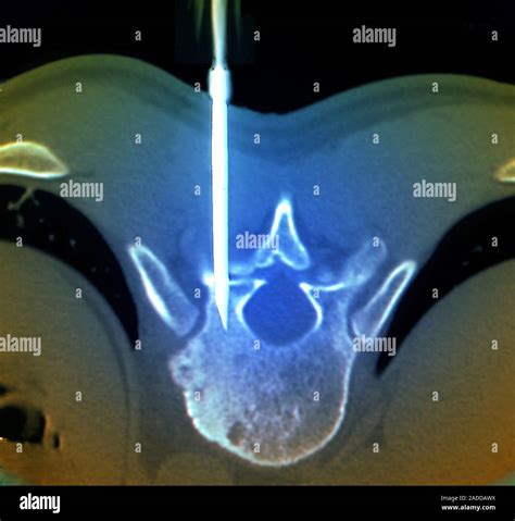 Treatment Of Secondary Bone Cancer In The Spine Coloured Axial