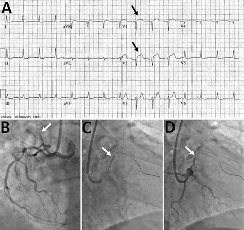 Figure 1 From Spontaneous Conus Branch Occlusion Mimicking Anterior St