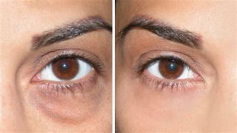 Makeup To Disguise Under Eye Bags Saubhaya Makeup