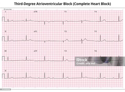 Mobitz Type 2 Second Degree Atrioventricular Block Ecg Paper 12 Lead