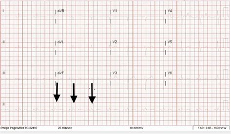 Electrocardiography Ekg Ekg Showing Low Voltage Qrs Complexes In Limb