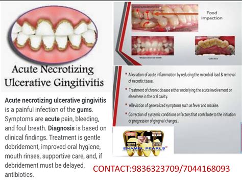 Necrotizing Ulcerative Gingivitis Before And After