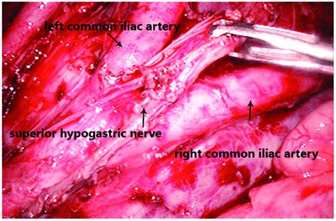 Preseration Of Autonomic Plexus After Removal Of Lymph Nodes Lymph