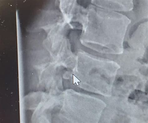 Sciatica Or Something Else R Sciatica