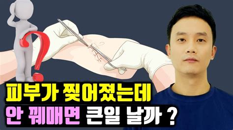 피부가 찢어졌을 때 꿰매야 되는 2 가지 이유 Youtube