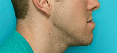 How Can Mewing Fix Underbite Ach