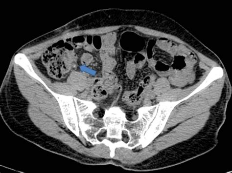 Stump Appendicitis With Appendicolith Eurorad