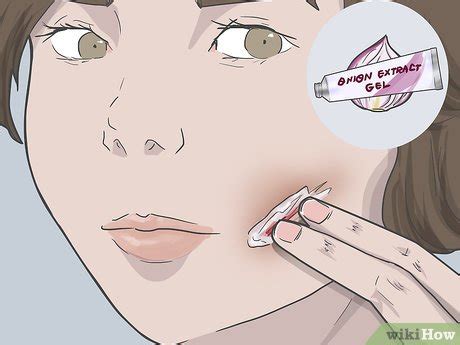 4 Easy Ways To Prevent Scarring On Your Face WikiHow