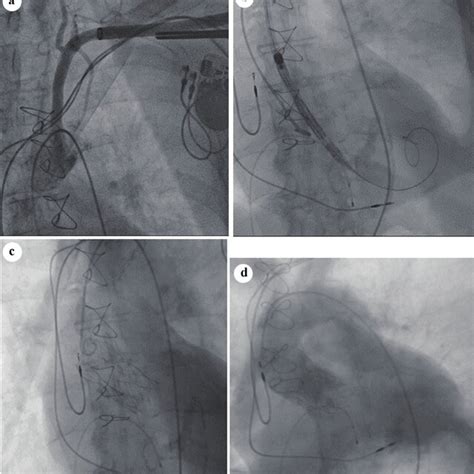 A Fluoroscopy Injection Confirming The Non Occlusive Position Of The