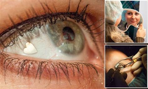 Eye Jewelry Implants