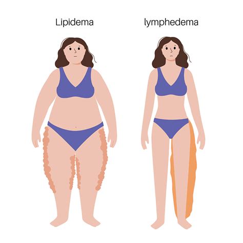 What Is Lipedema Dr Steff