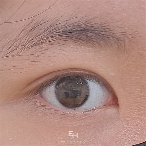 쌍꺼풀수술후기 7일 경과 쌍꺼풀 수술 비용 가격 비교 분석 네이버 블로그