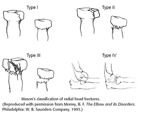 Fractures Of The Radial Head Mason Classification Orthopaedicsone Articles