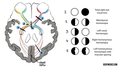 Neurological Visual Field Defect