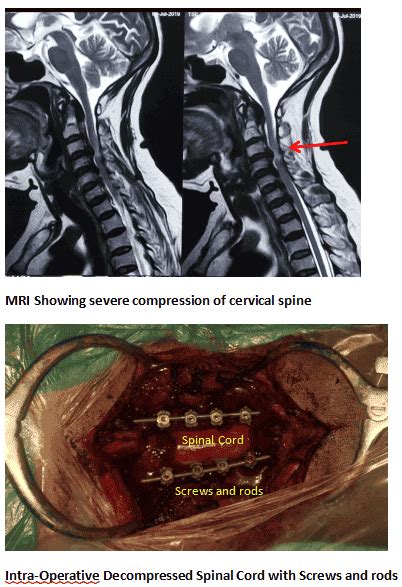 Cervical Laminoplasty Spine Surgery Spine Sure Clinic