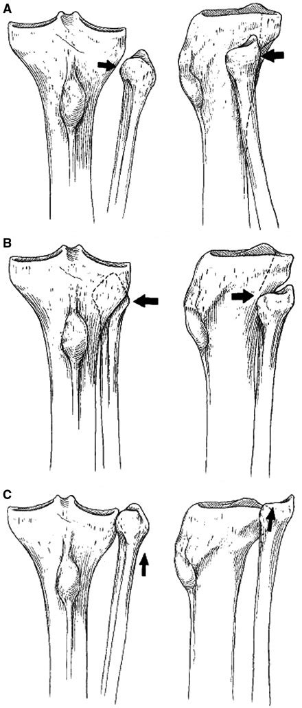 Proximal Tibiofibular Joint Dislocation Symptoms Caus