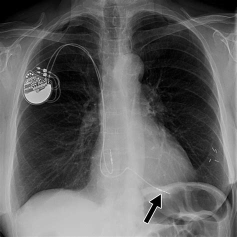 Chest Radiography In The Icu Part 2 Evaluation Of Cardiovascular