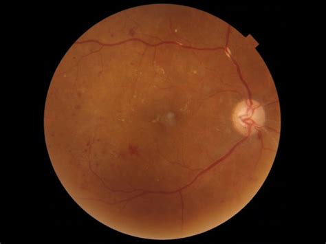Nabeel Refka On Linkedin Exudation On A Large Retinal Vein As A Sign