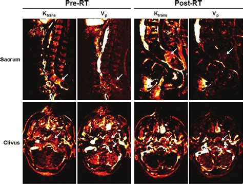 Perfusion Maps Of K Trans And V P Pre And Postradiation Therapy K Download Scientific Diagram