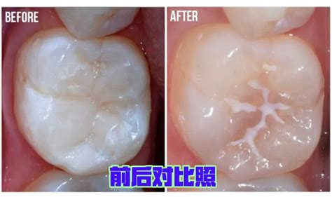 窝沟封闭到底几岁做？做了有用吗？