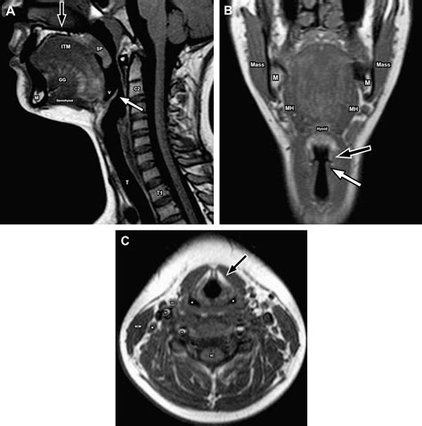 What Is A Mri Of The Neck At Erik Harris Blog