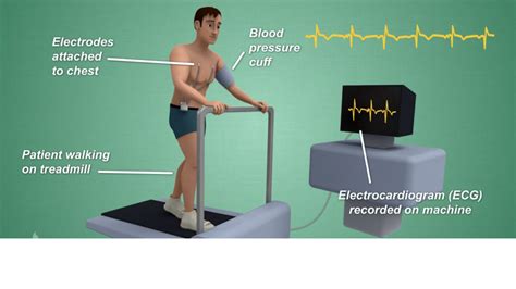 Treadmill Test Tmt Price Procedure Preparation And Results