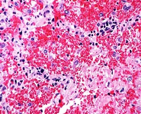 Alveolar Hemorrhage And Pulmonary Vasculitis Flashcards Quizlet