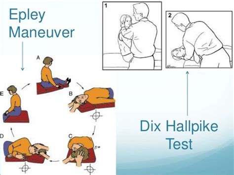 Epley Maneuver Dix Hallpike