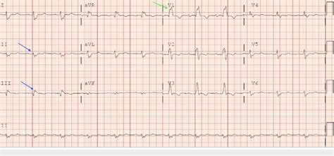 Blue Arrow Sinus Rhythm With Low Voltages In I II III Limb Leads Download Scientific