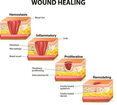 How Can Physiotherapy Help Chronic Wounds Van Sports And Physio