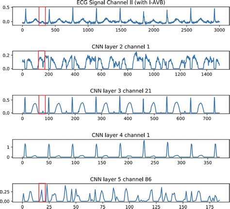 Features Extracted By Different Cnn Layers From Ecg Signals Download Scientific Diagram