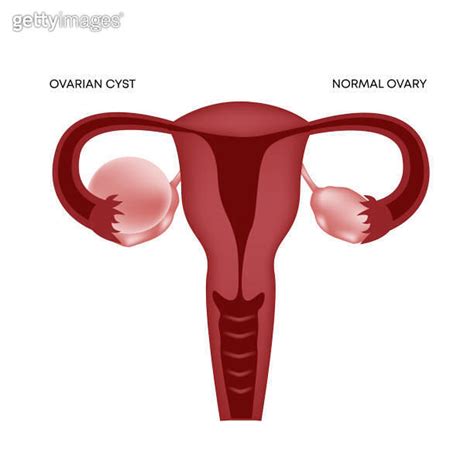 The Uterus And The Ovarian Cyst Female Reproductive System Vector