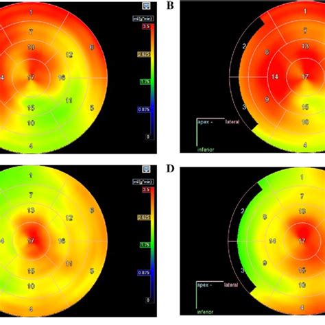 The 17 Segment Polar Maps Of The Two Subjects Classified Discordantly Download Scientific