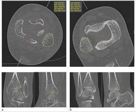 Plane Positioning And Bone Density Measurement Of Injured And Intact