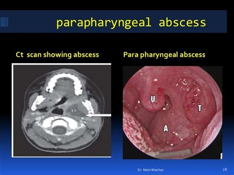 Lateral Pharyngeal Space Abscess