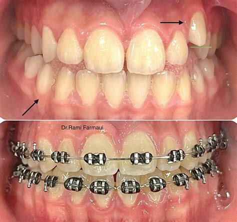 Specialized Красив случай на вече екстрахирани извадени първи кътници Пациентът искаше