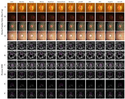 Visual Comparison For Fundus Optic Disc Cup And Prostate Mri Download Scientific Diagram